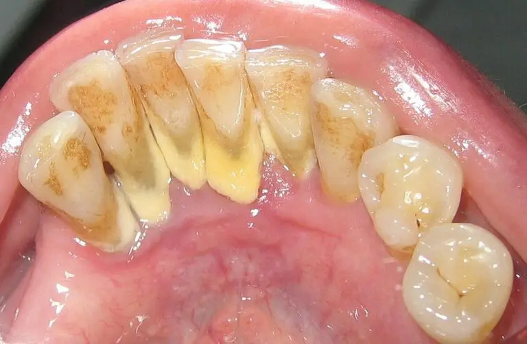 Calculus Bridges: Causes, Risks, Treatment | Smiley Dental